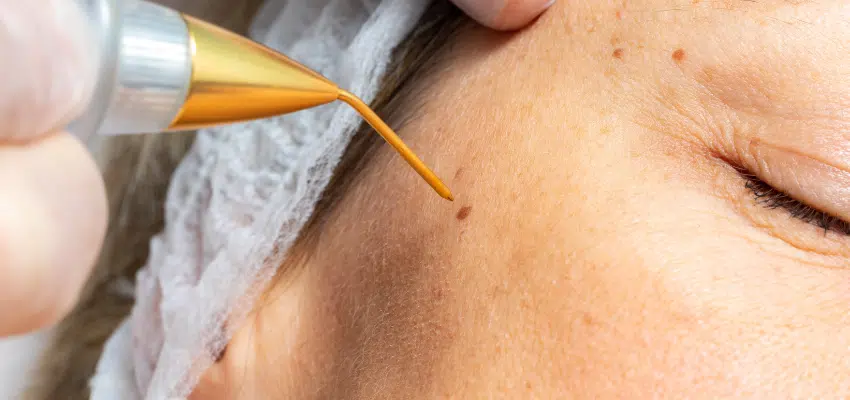 Plasma Fibroblast: What Is It And Does It Really Work?